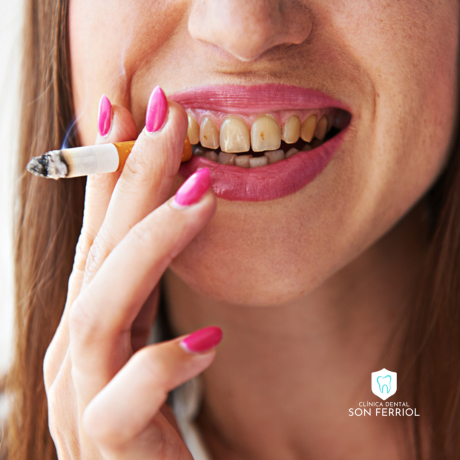 Cómo afecta el tabaco a nuestros dientes