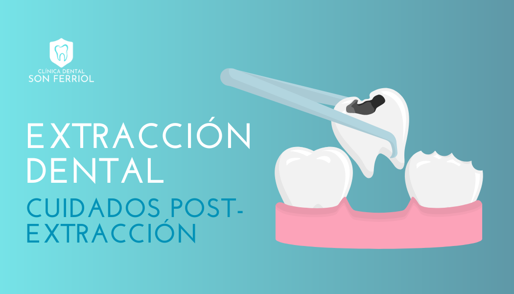 Extracción dental, cuidados post-extracción.